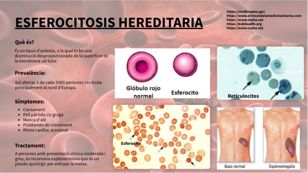 Esferocitosis Hereditaria | Genially