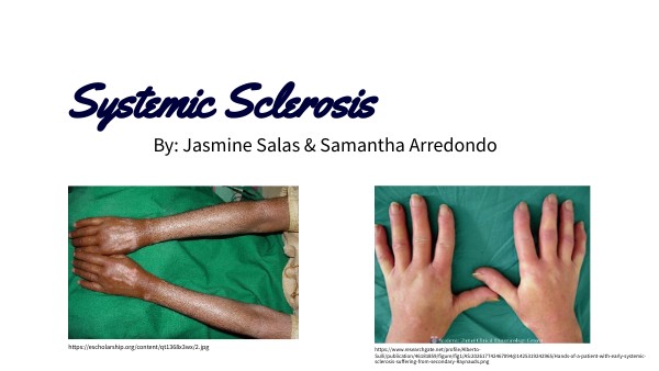 Systemic Sclerosis