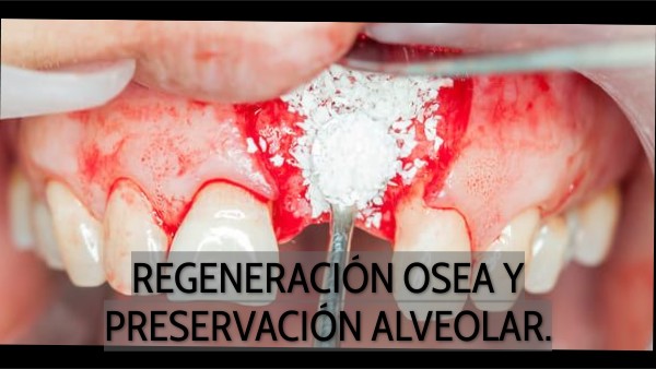 REGENERACION OSEA Y PRESERVACION ALVEOLAR