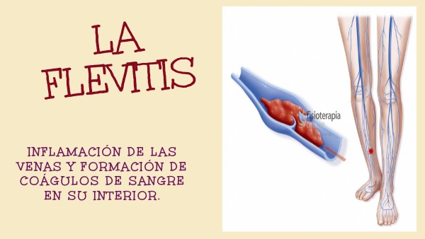 PRESENTACION SOBRE LA FLEBITIS | Genially
