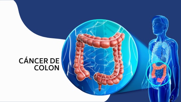 cancer de colon