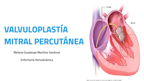 Valvuloplastia mitral | Genially