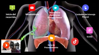 Neumotórax- Hemotorax