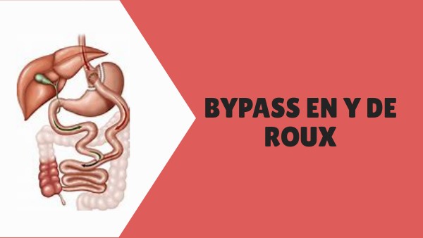 Bypass en Y de Roux-Grupo 3 | Genially