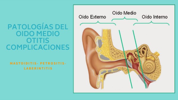 MASTOIDITIS-PETROSITIS-LABERINTITIS | Genially