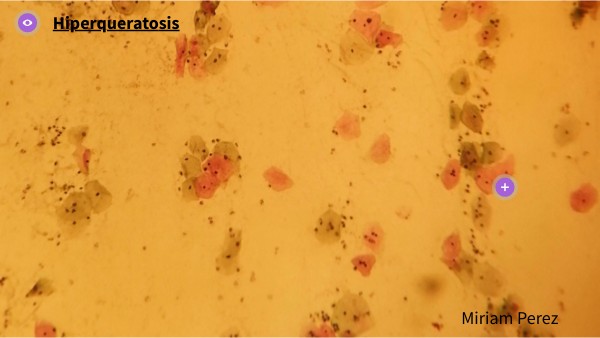 Células hiperqueratósicas