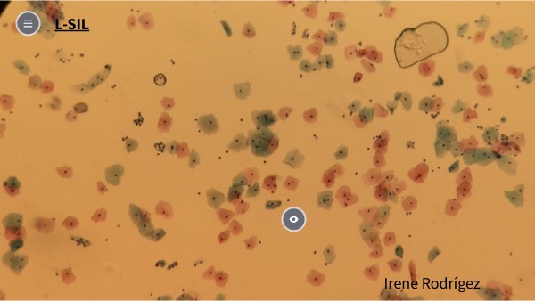 Coilocito citología líquida | Genially