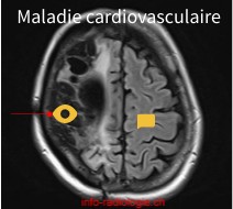 Infarctus cardiaque