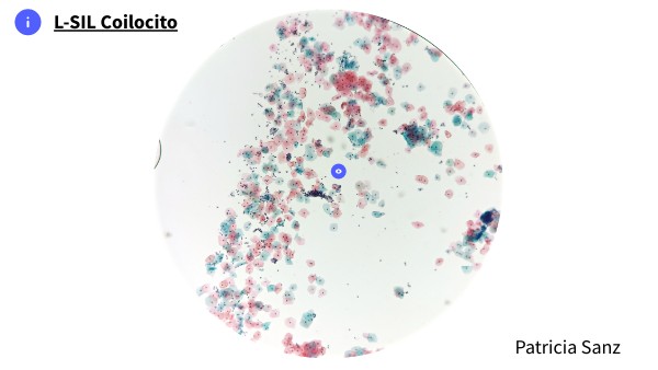 Coilocito en citología líquida de muestra ginecológica | Genially