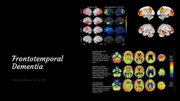 Frontotemporal dementia | Genially