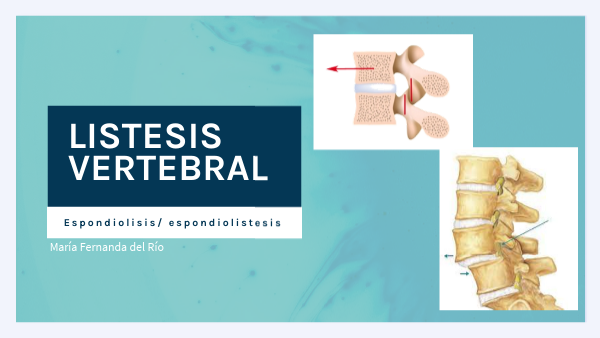 Listesis Vertebral | Genially