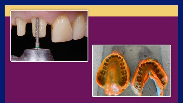 Yesos dentales | Genially