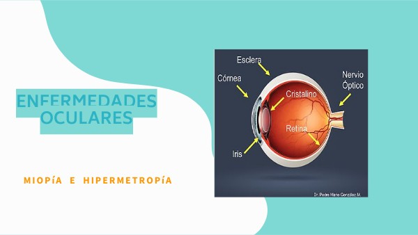 MIOPIA E HIPERMETROPIA María Millán