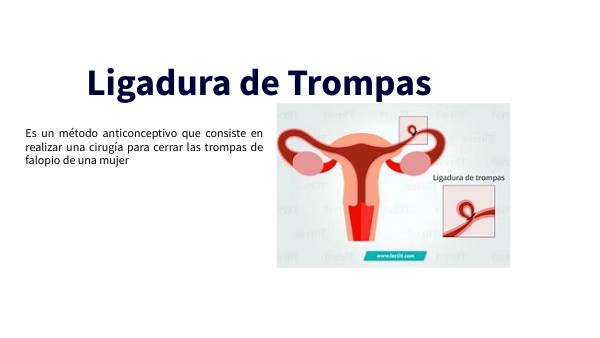 Ligadura de Trompas- Biologia 3C | Genially