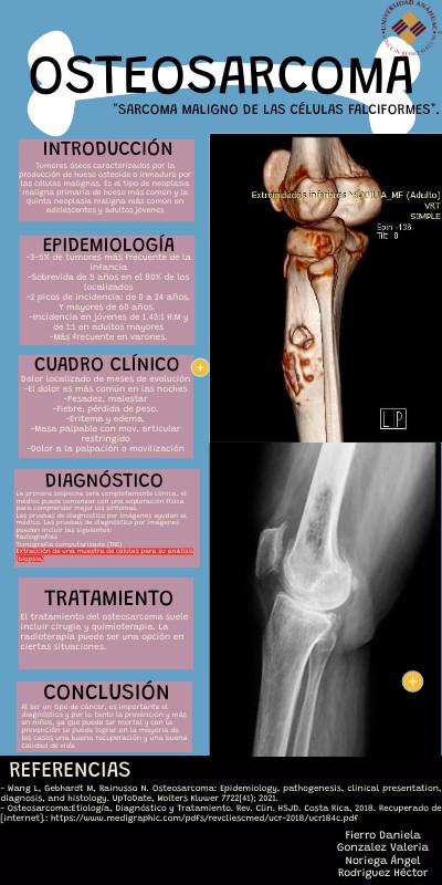 Osteosarcoma | Genially