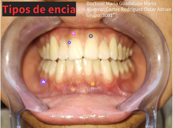 Tipos de encía