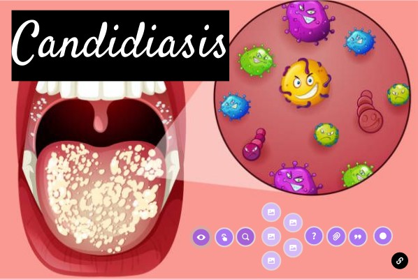 Candidiasis | Genially