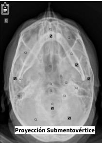 Proyección submentovértice | Genially