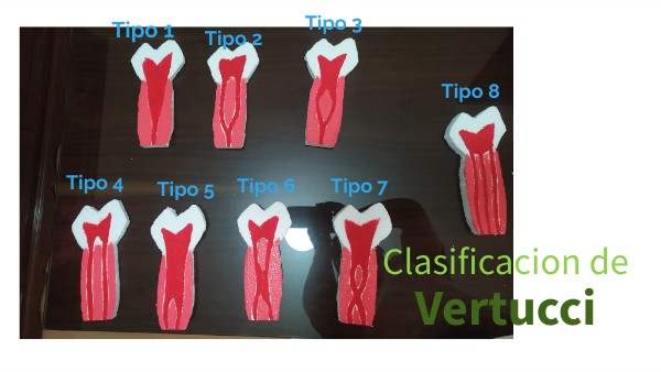 Clasificación Vertucci
