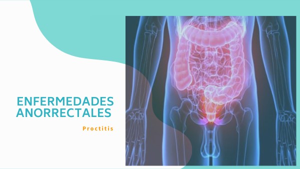 proctitis | Genially