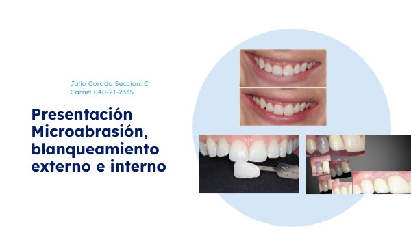 Microabrasion, blanqueamiento externo e interno