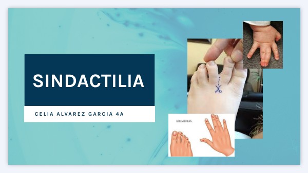 PRESENTACIÓN SINDACTILIA | Genially