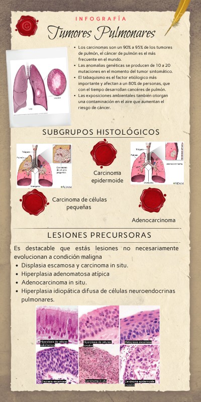 Infografía Tumores Pulmonares | Genially