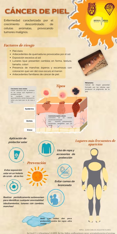 Cáncer de Piel | Genially