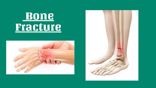 bone fracture