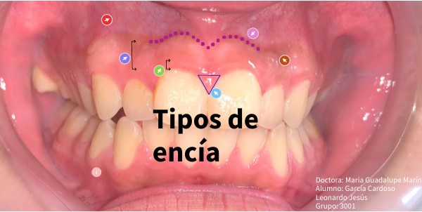 Tipos de encía | Genially
