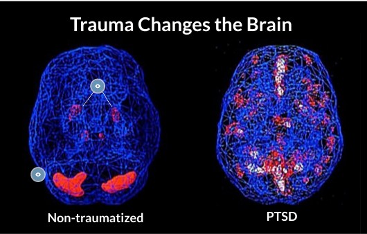 Trauma Changes the Brain | Genially