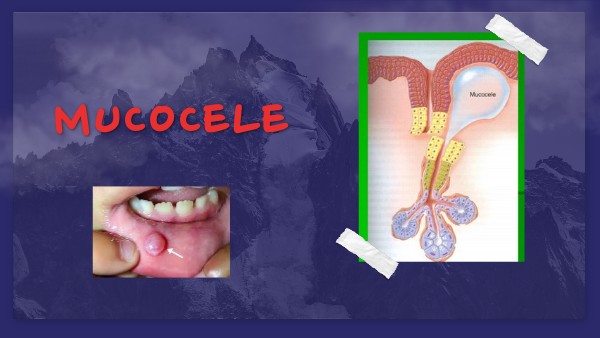 mucocele | Genially