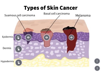 Types of Skin Cancer