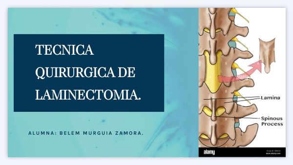PRESENTACIÓN LAMINECTOMIA. | Genially