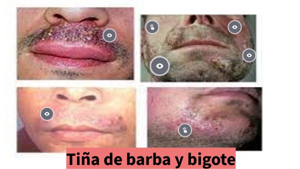 tiña de barba
