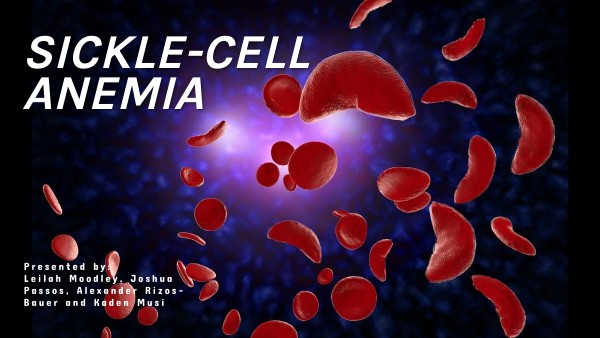Sickle Cell Anemia presentation