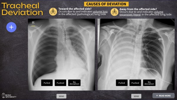 Tracheal Deviation on CXR