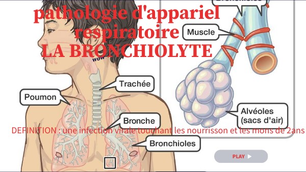 LA bronchiolite | Genially