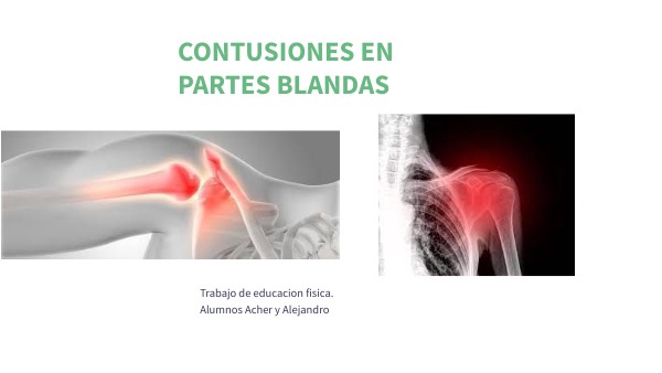 Presentacion sobre contusiones en partes blandas