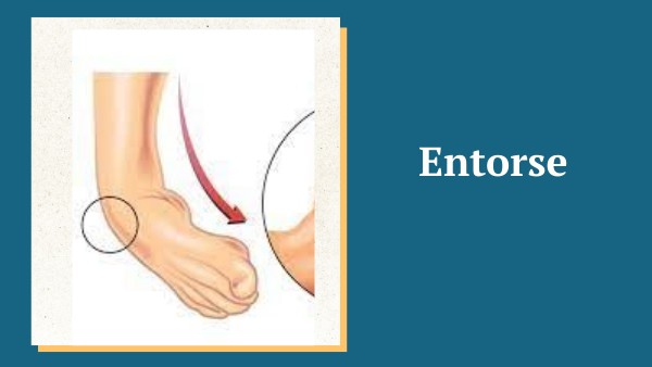 entorse