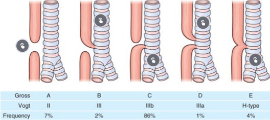 Different Types Of Esophageal Atresia