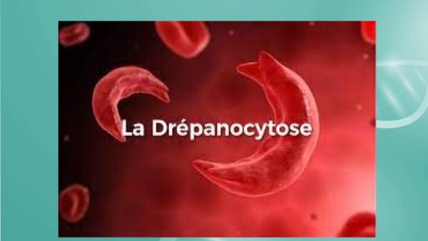 drepanocytose | Genially